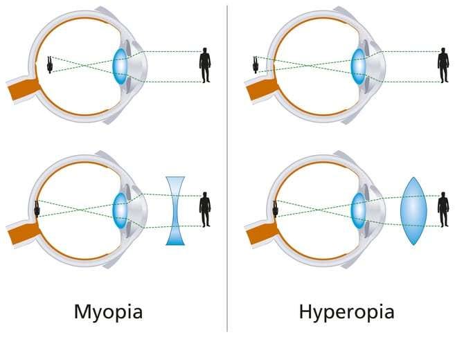 Myopia Vs Hyperopia. Hyperopia | by Local Bounti | Medium