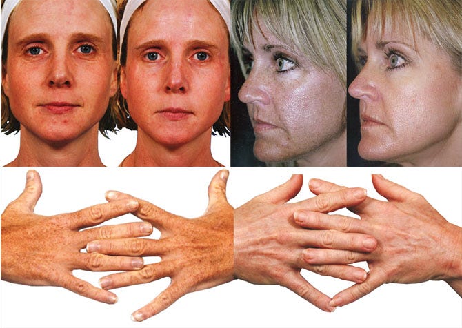 Who Can Be An Ideal Candidate For Laser Resurfacing In Chicago? | by ...