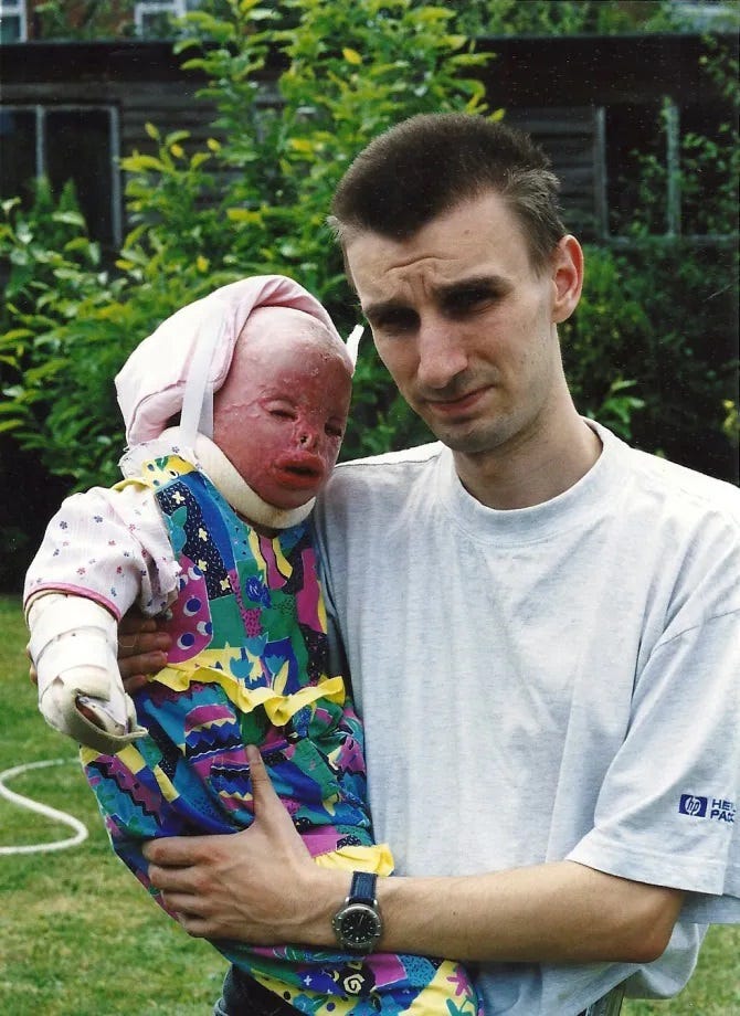 A Face Burned Off. In 1998, little Terri Calvesbert was… | by fran ...