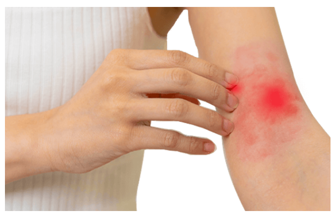 skin rashes treatment - KBK Facebook Ads - Medium