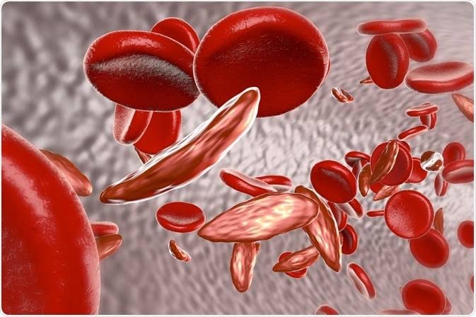 SICKLE CELL DISEASE. Author: Pharm Evwaire Oghenetega | by Psnypg | Medium