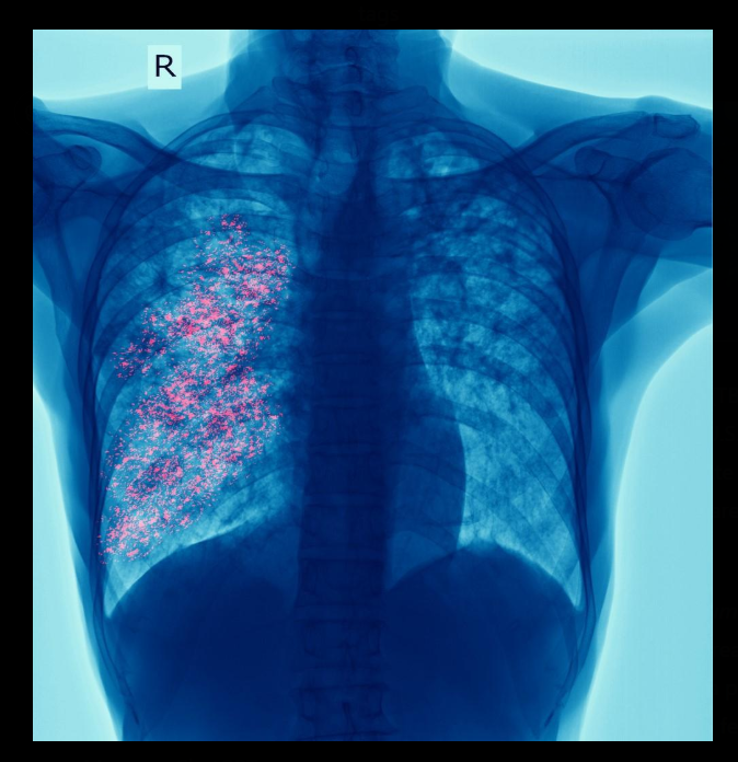 Kansas Confronts Largest Tuberculosis Outbreak in U.S. History | by ...