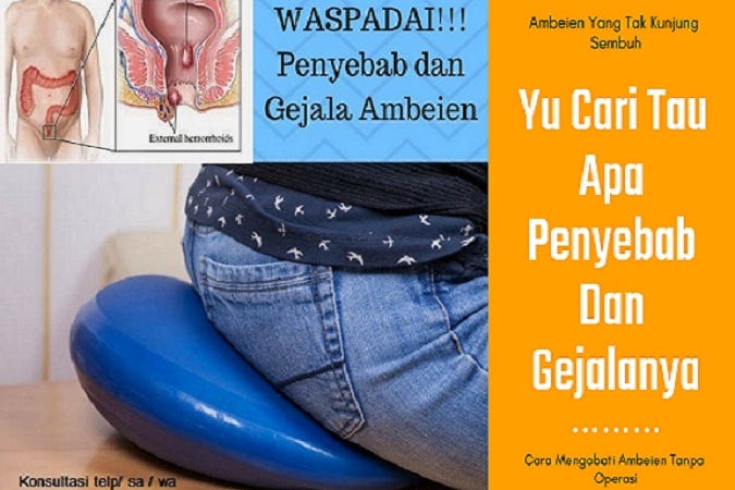 Apa Itu Wasir Dan Cara Mengobati. Apa Itu Wasir Dan Cara Mengobati —… | by Cara Sembuhkannya ...