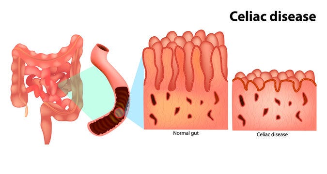 What are the complications associated with celiac disease? - Globus ...
