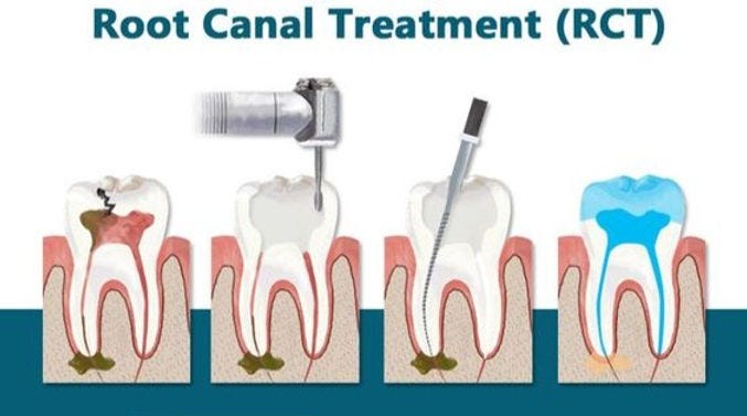 Root Canal | RCT of Teeth | Endodontics | RCT Treatment | by ...