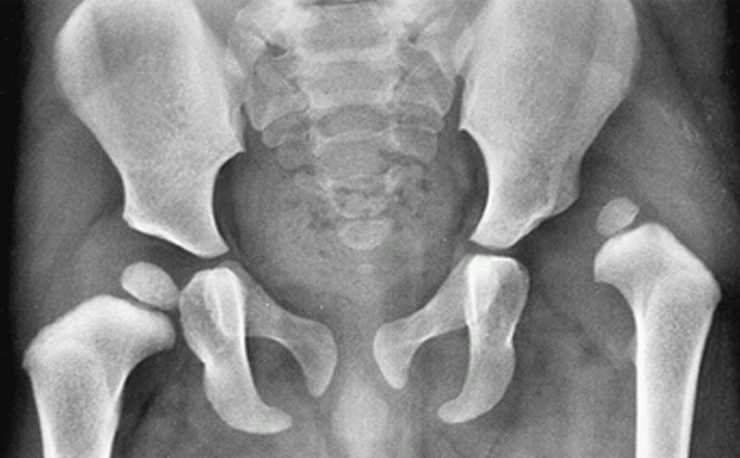 Congenital Hip Dislocation in Children in India: Causes, Treatment, and ...