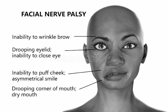 Physiotherapy For Facial Palsy Facial Palsy Is A Paralysis On One Side