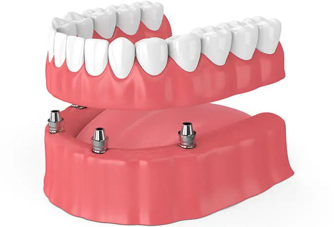 A Detailed Guide to All on 4 Dental Implants: What to Understand | by ...
