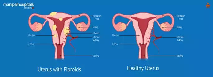 Uterine Fibroid Embolisation Procedure And Its Advantages | by Manipal ...