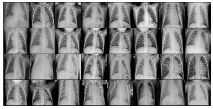 Detecting Pneumonia In Chest X Rays With Convolutional Neural Networks