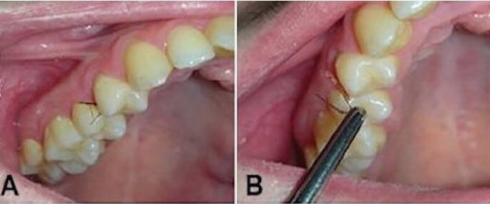 Oral hair growth — practically unheard | the_pill_bar