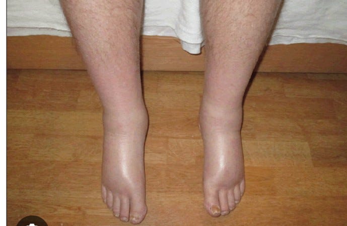 Bilateral leg swelling with Diabetes type 2 | by Kokila Ranjith ...