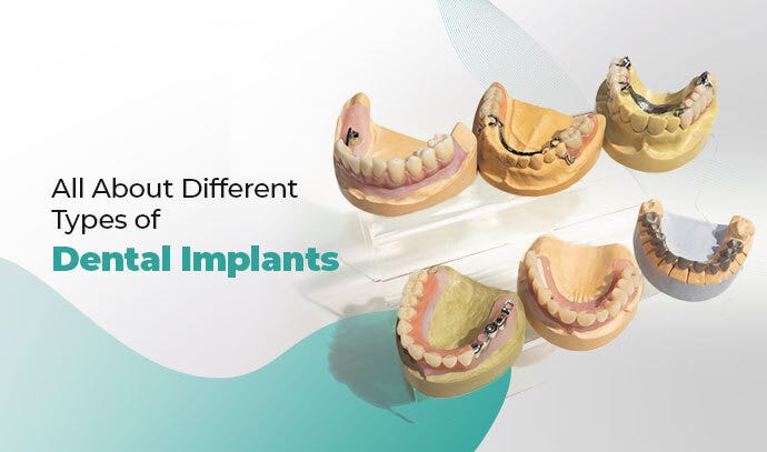 What are dental implants, and how do they differ from other tooth ...