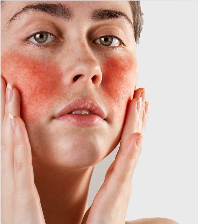 Skinception™ Rosacea Relief Serum — How to Get Rid of Rosacea ...