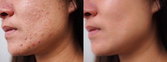 Natural ways to get rid of pimples in just 24 Hours | by Rosan Sah | Medium