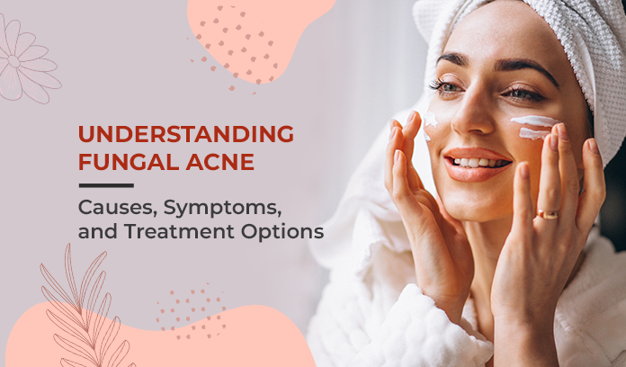 A Complete Guide to Understanding and Treating Fungal Acne | by Acne Wiki | Sep, 2023 | Medium