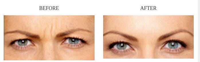 Best Botox Treatment In Montreal By Dr Gaby Doumit By Dr Gaby Doumit