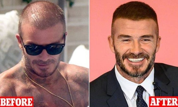 David Beckham Plastic Surgery Procedure in Turkey - Plastic Surgery ...