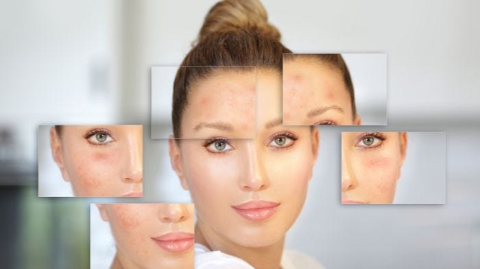 What is Purging Acne? | by Medicalcave | Medium
