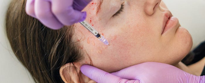 Twilight Transformation: Decoding the Vampire Facial Phenomenon | by ...