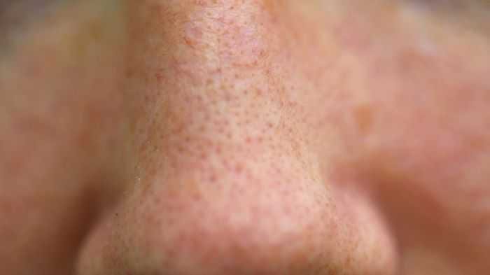 Why Do i Have Acne On My Nose | by Medicalcave | Medium