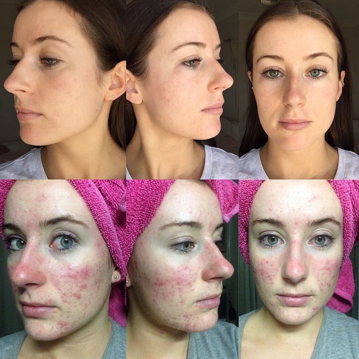 Acne scars can be a major irritation to those who suffer from them, for ...