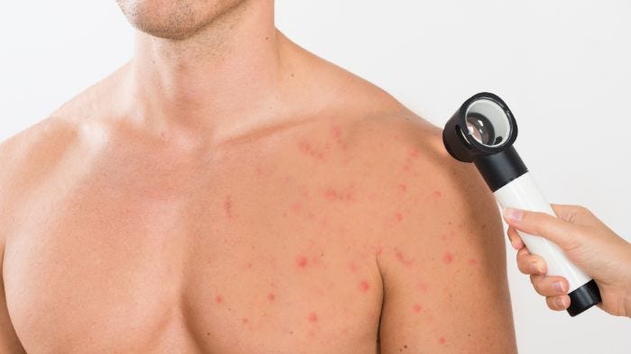 How To Get Rid of Chest Acne Naturally | by Medicalcave | Medium