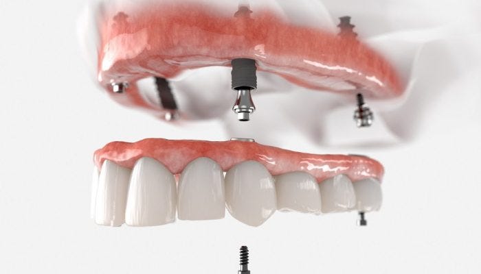 All-On-4 Dental Implants in San Diego | Medium