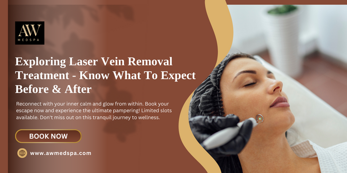 Exploring Laser Vein Removal Treatment — Know What To Expect Before ...