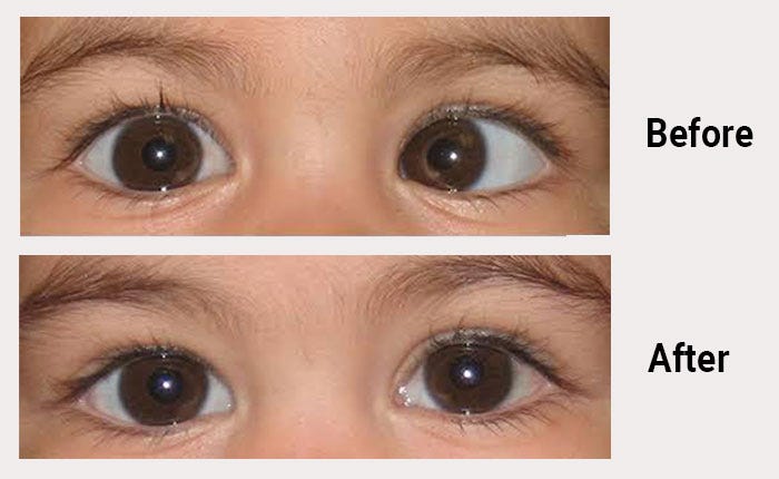 What is the Treatment for Squint Eye? | by Bharti eye Foundation | Sep ...