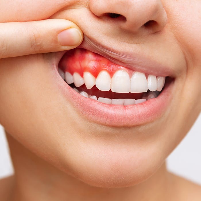 What is pyorrhea and its types?. Oral health is very crucial for the ...
