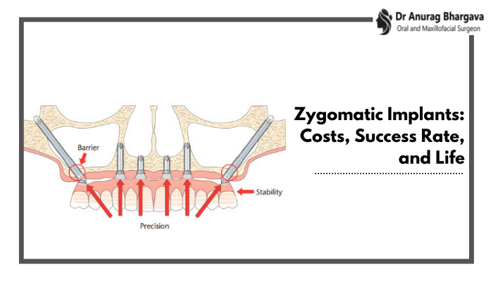 Everything You Need to Know About Zygomatic Implants: Costs, Success ...