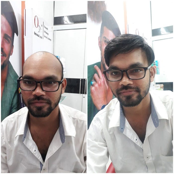 Hair Weaving in Puri - Hairfixsolution - Medium