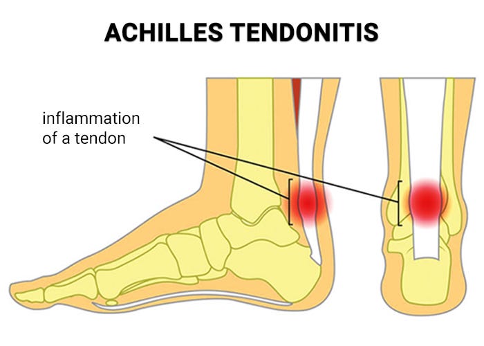Achilles Tendon Surgery NJ. You may have seen a player getting… | by ...