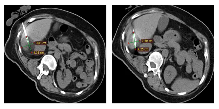 Liver Cancer. What is Cryotherapy for Liver Cancer? | by hygeamedtech ...