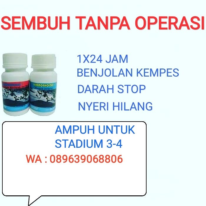 MEMAHAMI STADIUM WASIR :. 1.Wasir Tingkat Pertama | by SUPLEMEN HERBAL ...