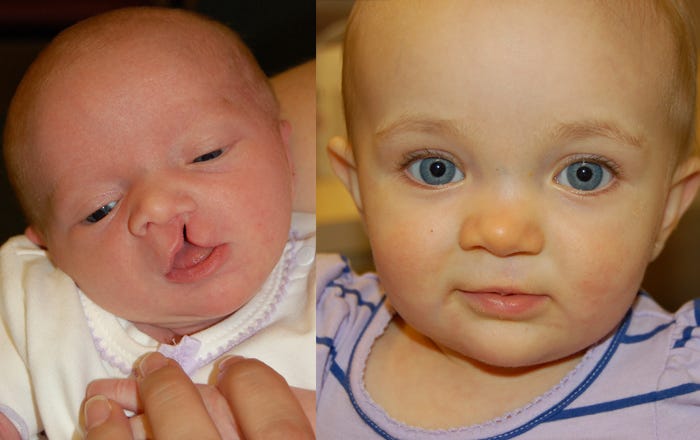 The Puzzle of Cleft Surgery. Dr. Ralph Millard, Jr.’s now classic… | by ...