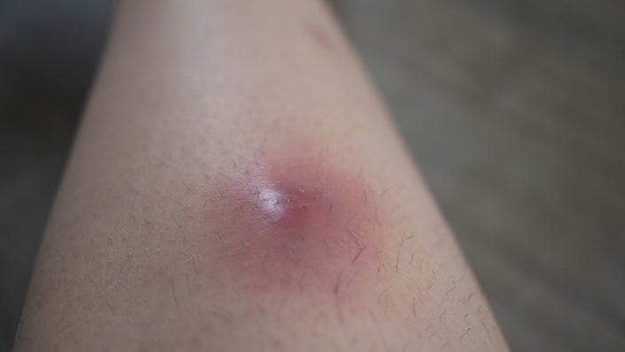 Tackling Abscesses in Dubai: Strategies and Solutions | by ...