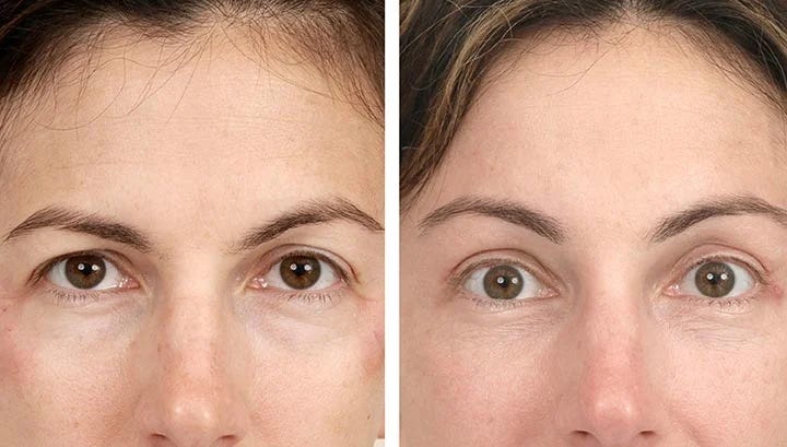 Discover The Magic Of Pdo Threads A Quick Guide To Achieving Youthful Eyebrows Through Pdo