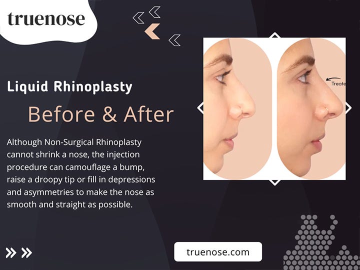 Liquid Rhinoplasty Before & After - TrueNose - Medium