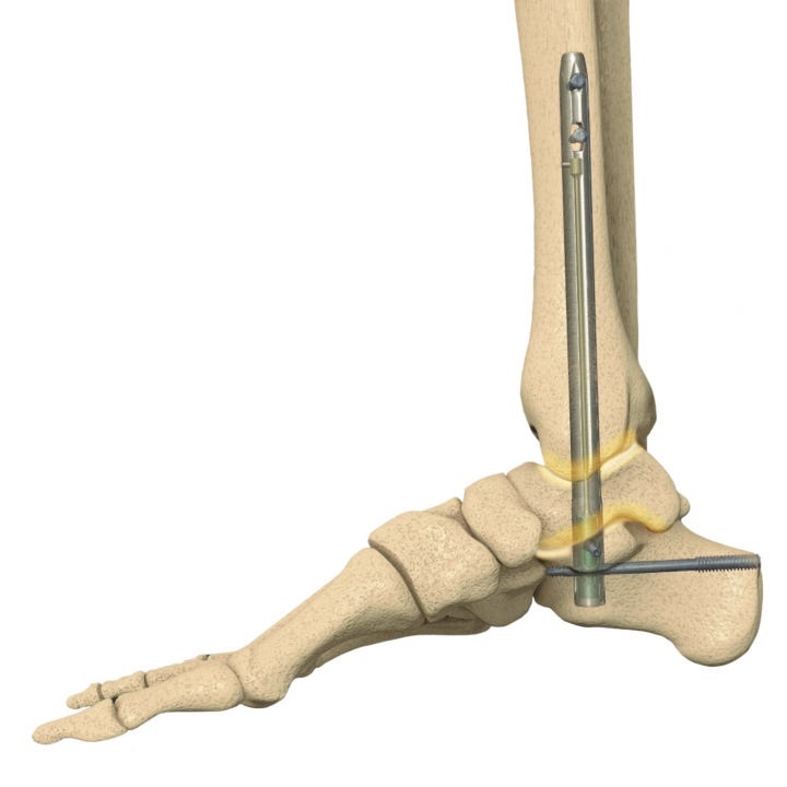 Who Needs Hindfoot Fusion and What to Expect? | by DJO® | Medium