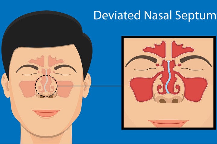 The Details to Emphasize About Deviated Nasal Septum Surgery | by ...
