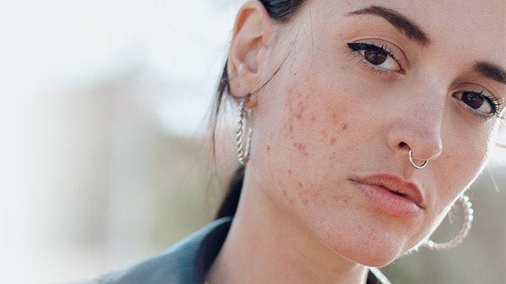 10 Reasons Your Skin Is Suddenly Breaking Out - Medrot - Medium