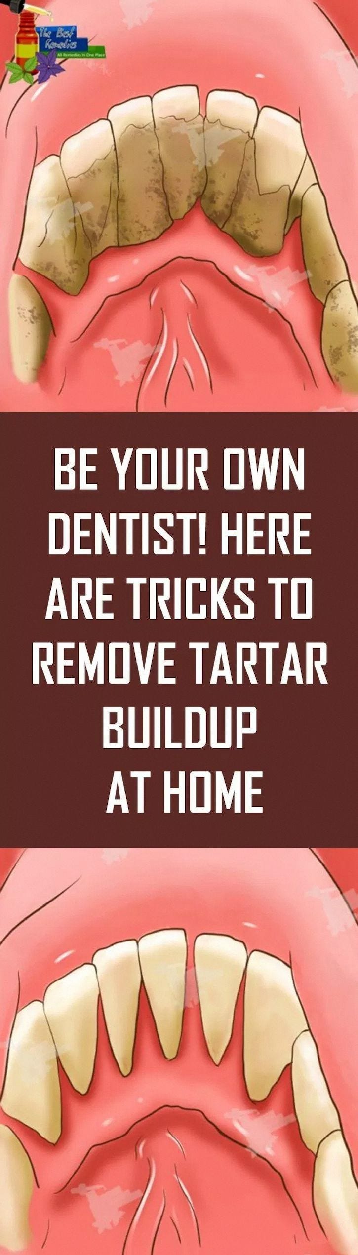 BE YOUR OWN DENTIST! HERE ARE TRICKS TO REMOVE TARTAR BUILDUP AT HOME ...