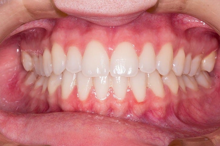 Discover Effective Methods on How to Treat Red Gums Naturally at Home ...