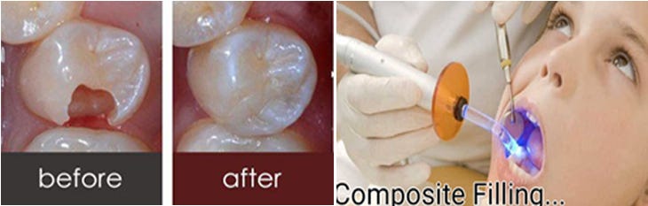 Milk Tooth Fillings. Back in days all parents thought that… | by ...
