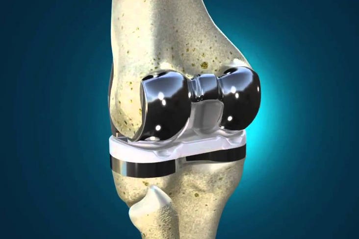 Collagen Meniscus Implant: Revolutionizing Meniscus Repair Techniques ...