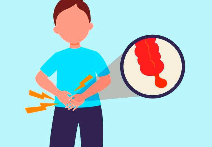 What Makes The Appendix Burst?. And why does it hurt so much? | by ...