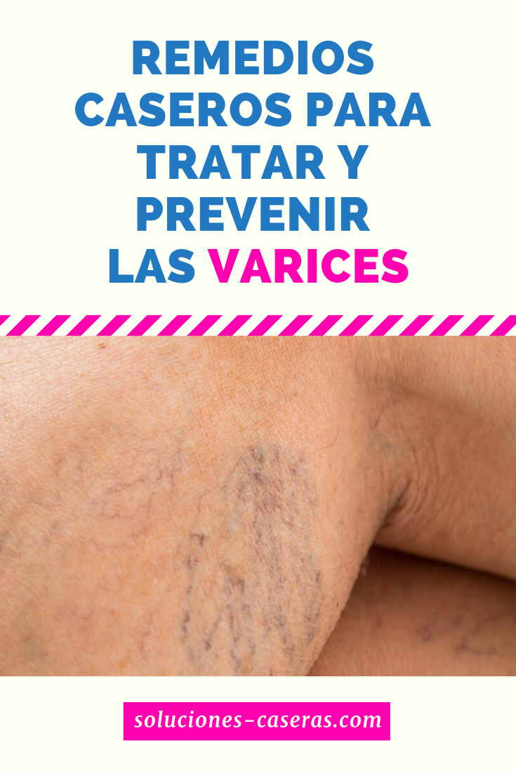 Remedios naturales para combatir las varices - Doctor Consejos - Medium