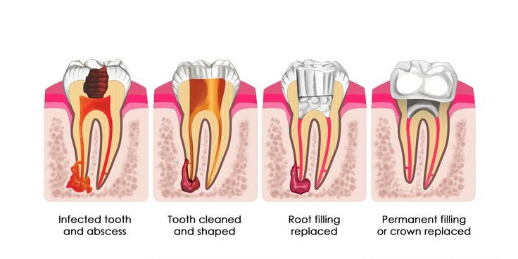 Understanding Root Canal Treatment for Multiple Teeth | by Amit Pandey ...